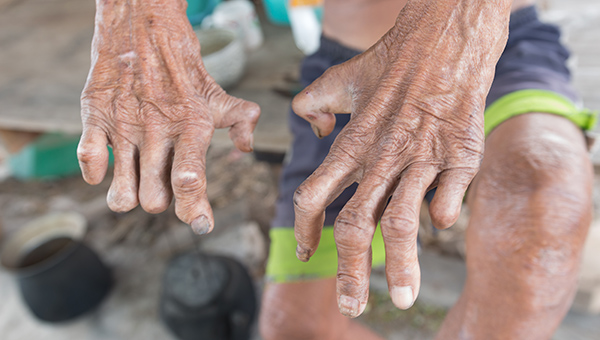 Towards 'Zero Leprosy' - model shows 40 million people need preventive ...
