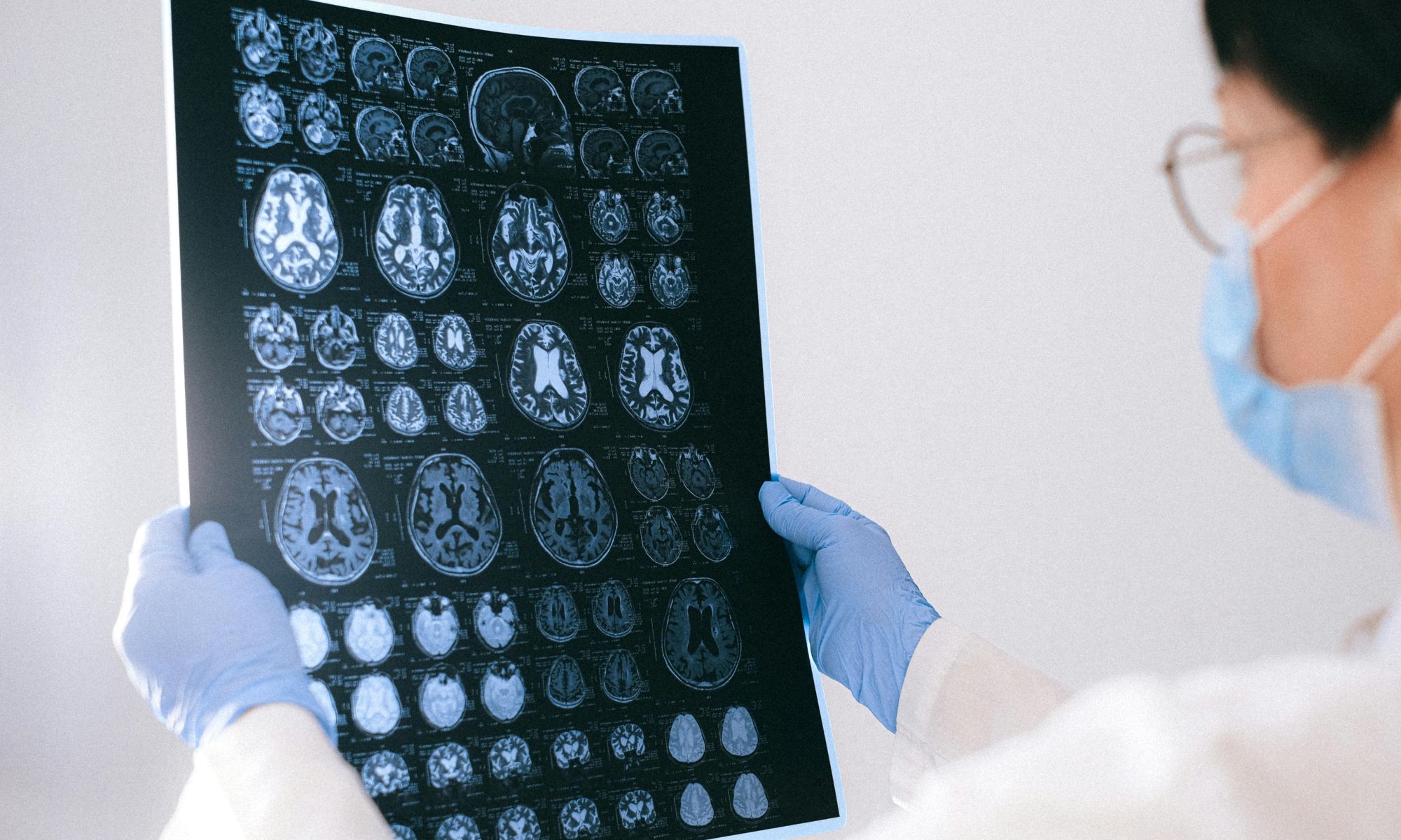 Huntington’s result 'could boost' ALS/frontotemporal dementia therapy ...